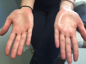 Palmar Hyperhidrosis NYC | The Center for Hyperhidrosis